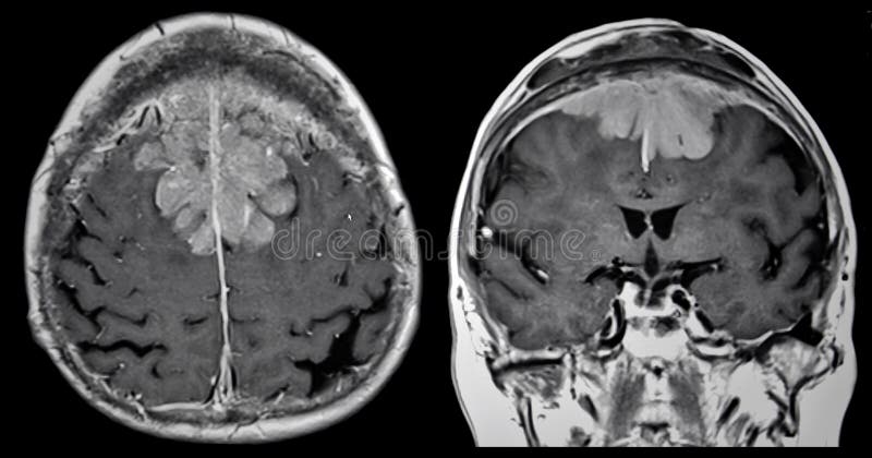 MRI Scan stock photo. Image of psychiatry, film, injury - 3417694