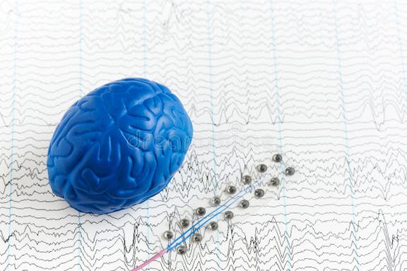 Brain Electrode Implant Stock Photos - Free & Royalty-Free Stock Photos ...