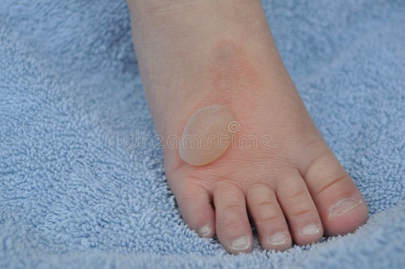 Brandblase stockfoto. Bild von verletzt, verletzung, blase - 38708260