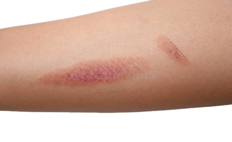 Brandwunde auf Haut stockfoto. Bild von schmerzlich - 113135414
