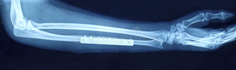 Bras De Radiographie Pour Film Photo stock - Image du rupture, film ...