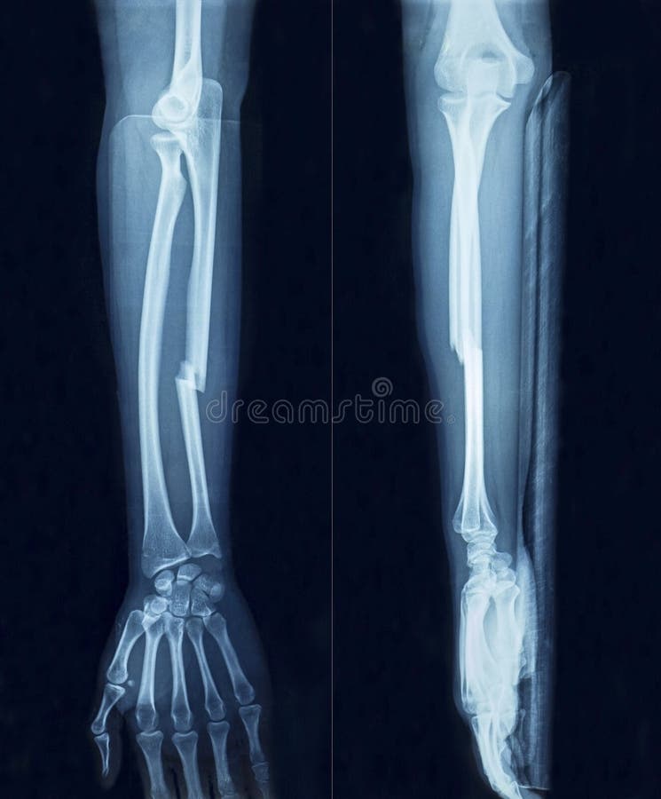 Bras De Radiographie Pour Film Photo stock - Image du rupture, film ...