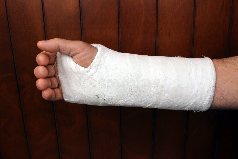 Brazo en yeso imagen de archivo. Imagen de cordura, yeso - 34815255