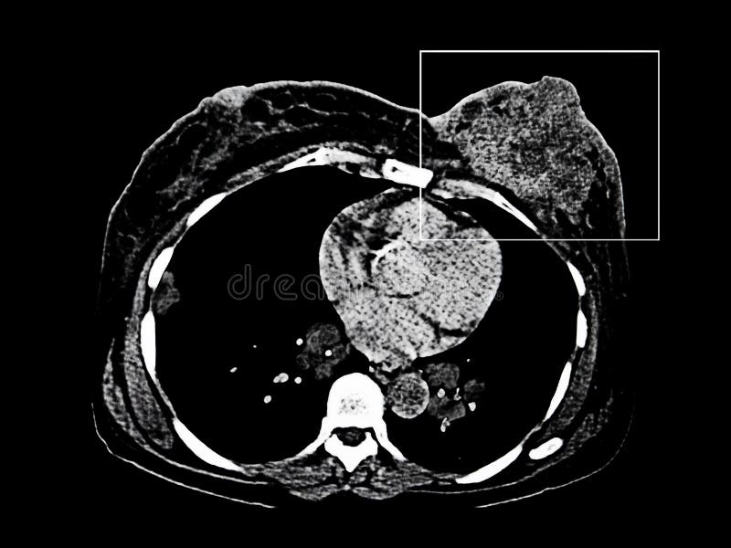Ct Scan Breast Clip Stock Photos - Free & Royalty-Free Stock Photos ...