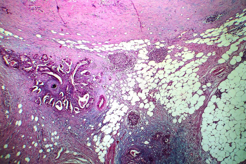 Breast Cancer, Light Micrograph Stock Photo - Image of cancer, medicine ...