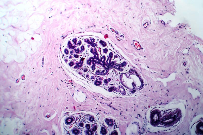 Breast Cancer, Light Micrograph Stock Image - Image of magnification ...