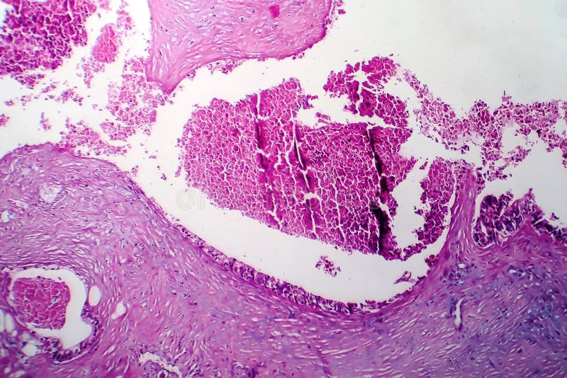 Breast Cancer, Light Micrograph Stock Photo - Image of micrograph ...