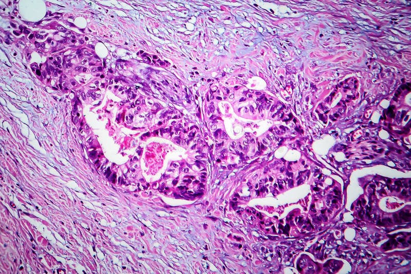 Breast Cancer, Light Micrograph Stock Image - Image of disease, women ...