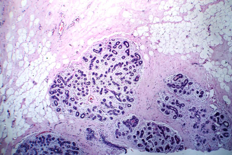 Breast Cancer, Light Micrograph Stock Photo - Image of histopathology ...