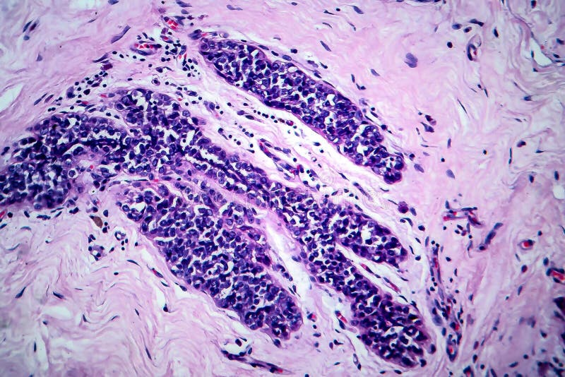 Breast Cancer, Light Micrograph Stock Image - Image of magnification ...