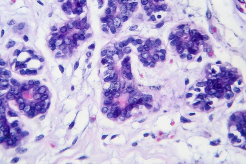 Breast Cancer, Light Micrograph Stock Photo - Image of breast, oncology ...