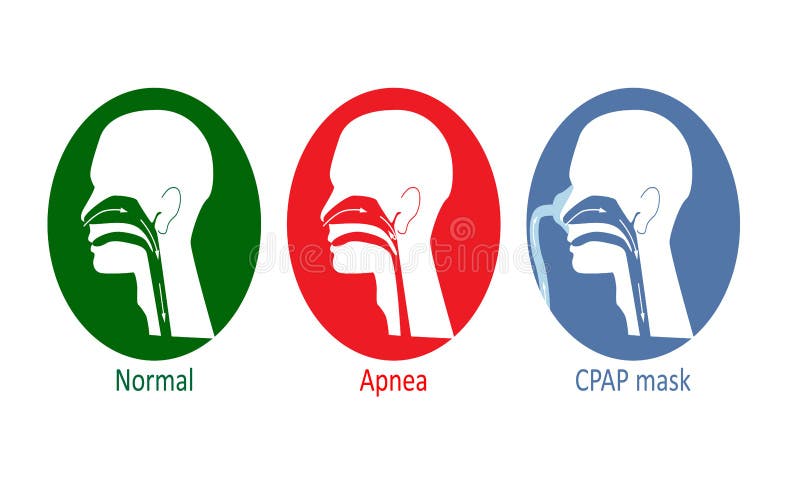 Cpap Stock Illustrations – 118 Cpap Stock Illustrations, Vectors ...