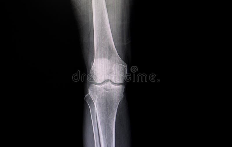 Breuk tibial plateau stock afbeelding. Image of orthopedisch - 129019723