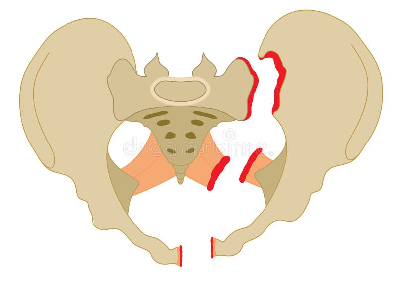 Breuk van het bekken vector illustratie. Illustration of gezondheid ...