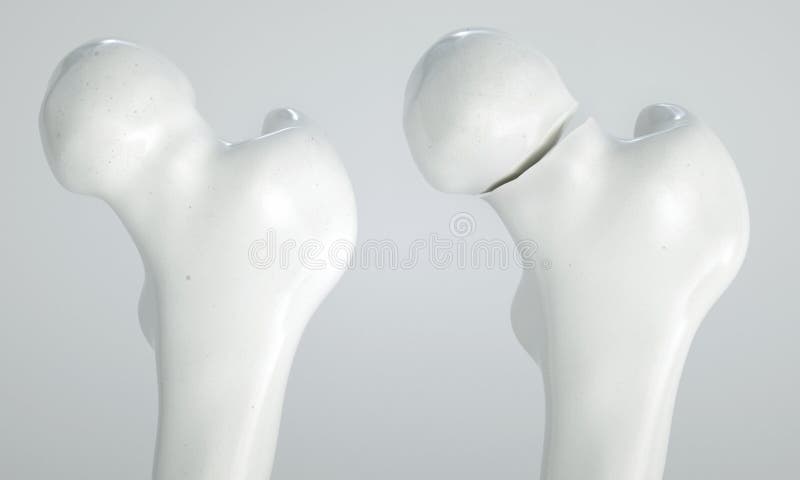 Breuk Van Het Dijbeen - Behandeling Met Schroeven - Het 3D Teruggeven ...