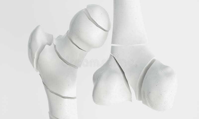 Breuk Van Het Dijbeen - Behandeling Met Schroeven - Het 3D Teruggeven ...