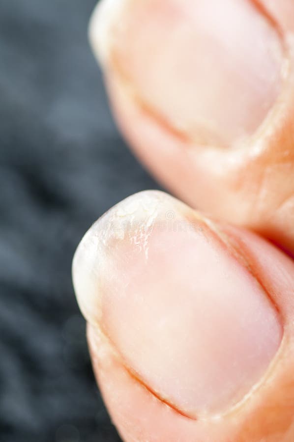 Brittle Damaged Fingernails Stock Image - Image of macro, peeling: 58330609