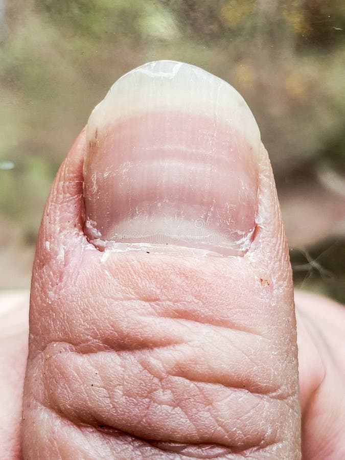 Dry Winter Hands in Need of Manicure. Stock Photo - Image of winter ...