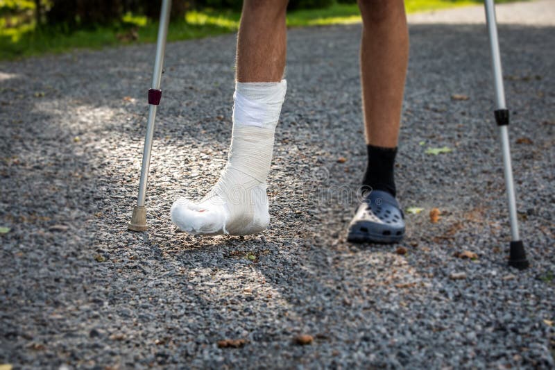 Broken Ankle and a Leg Cast. Leg Splint Imagen de archivo - Imagen de ...