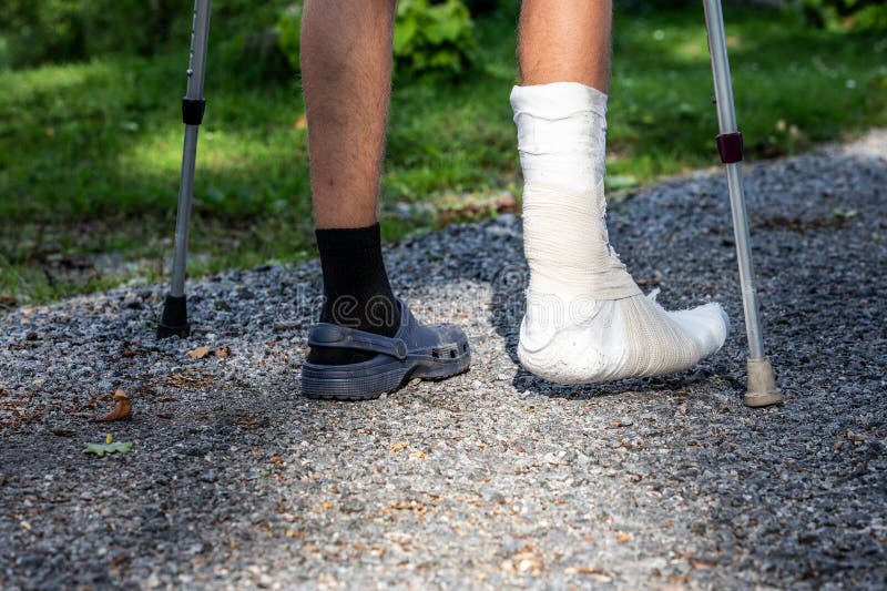 Broken Ankle and a Leg Cast. Leg Splint Stock Image - Image of bone ...
