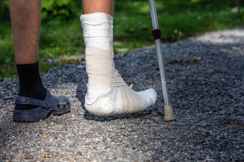 Broken Ankle and a Leg Cast. Leg Splint. Stock Photo - Image of broken ...