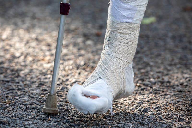 Broken Ankle and a Leg Cast. Leg Splint Stock Image - Image of assist ...