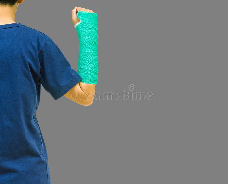 Broken Arm Bone in Green Cast on Gray Background. Stock Photo - Image ...