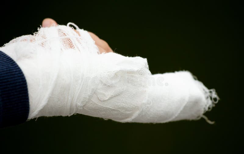 Broken Arm in a Cast in a Boy. Stock Photo - Image of child, cast ...