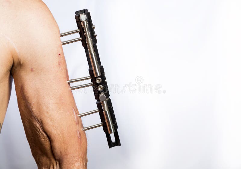 Broken Arm with External Metal Fixator Stock Photo - Image of illness ...