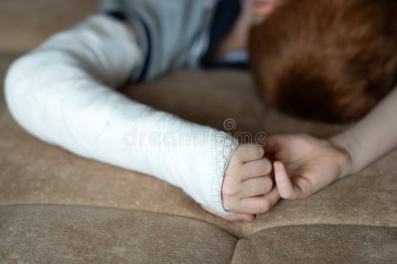 Broken Arm with Plaster Cast Stock Image - Image of emergency, cure ...