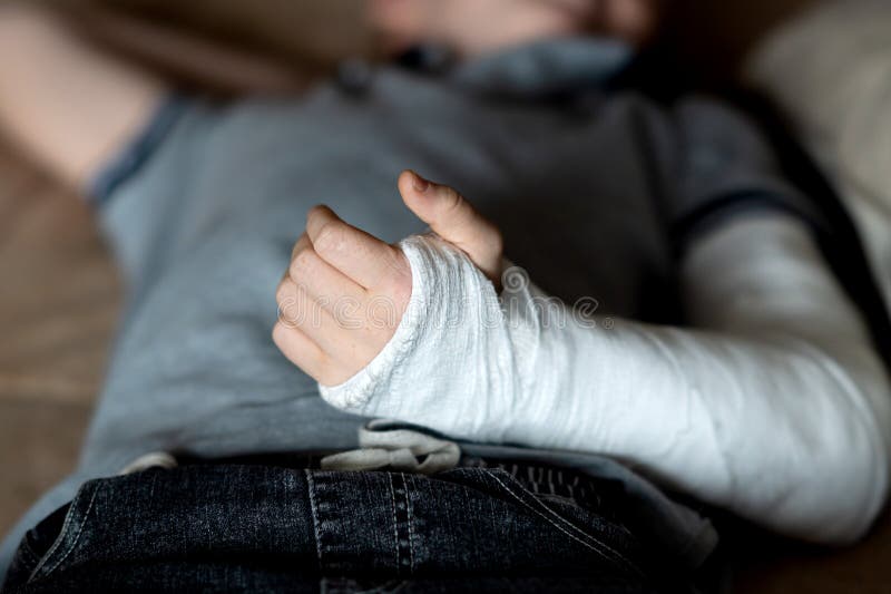 Broken Arm with Plaster Cast Stock Photo - Image of lifestyle, damage ...