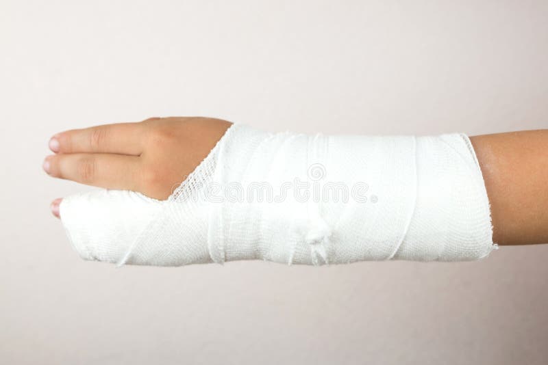 Broken Arm with a Plaster Cast on White Stock Image - Image of cast ...