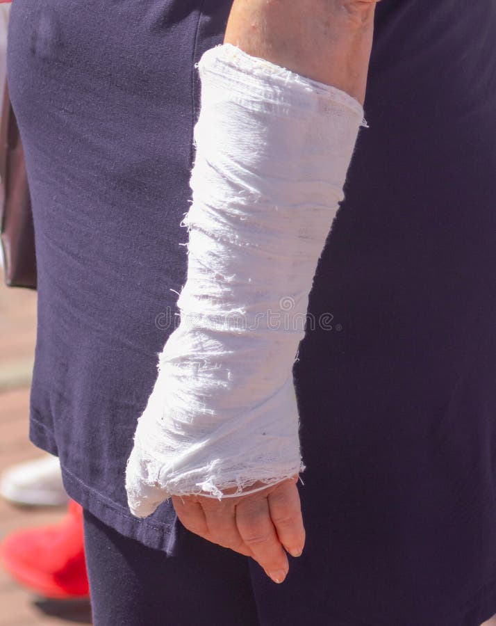A Broken Arm in a Woman`s Cast Stock Image - Image of human, medical ...