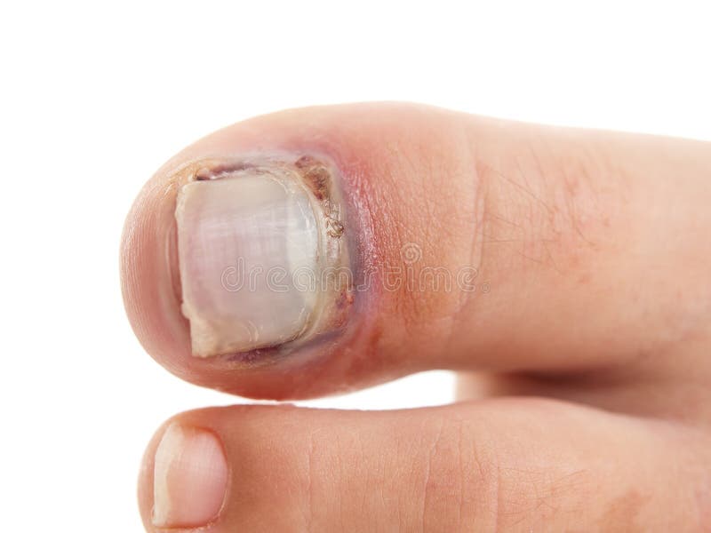 Broken Big Toe with Nail Detachment Stock Photo - Image of injured ...