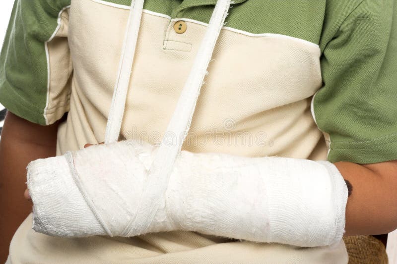 Broken bone stock image. Image of broken, hand, medical - 5105267