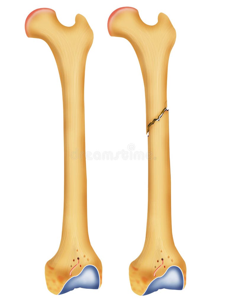 Broken Bones Stock Illustrations – 1,658 Broken Bones Stock ...