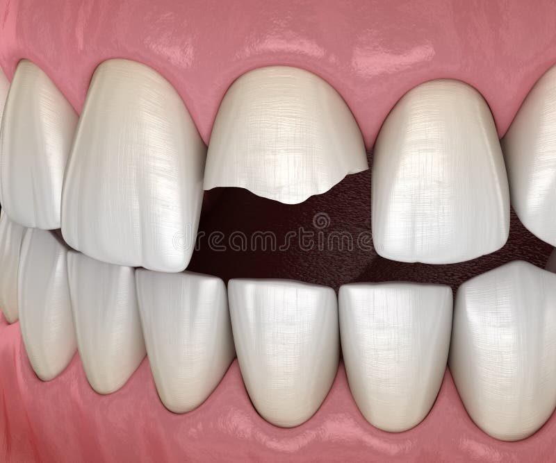 Broken Central Incisor Tooth. Medically Accurate 3D Illustration of ...