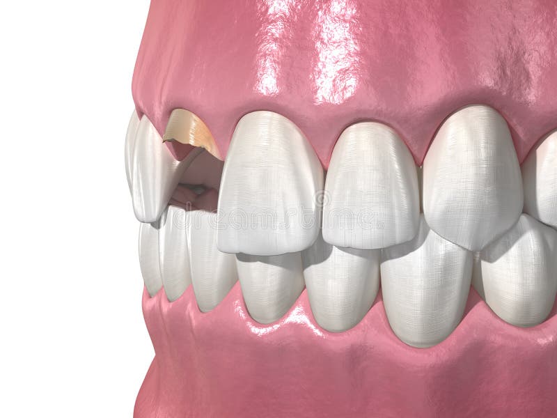 Broken Central Incisor Tooth. Medically Accurate 3D Illustration of ...