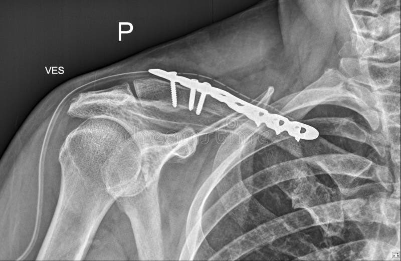 Broken Clavicle Bone, Shoulder Medical Xray Stock Image - Image of ...