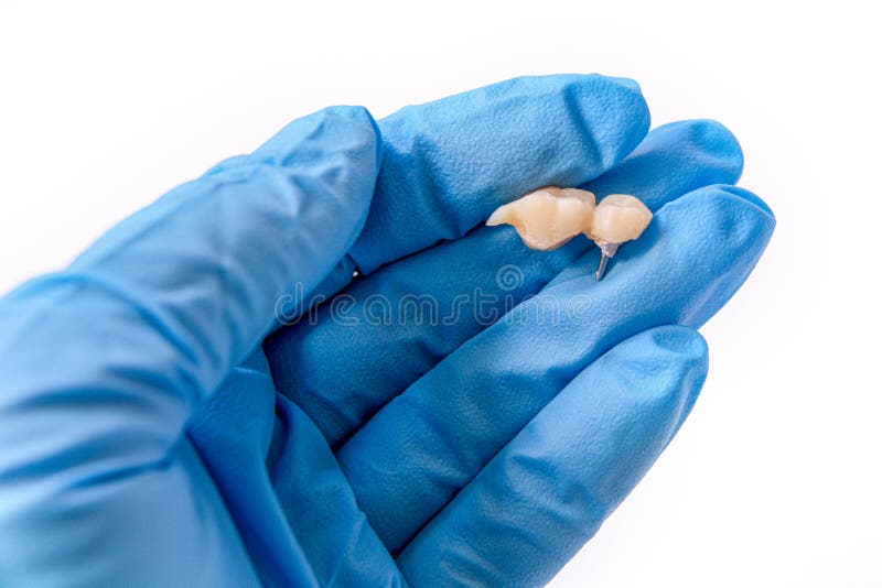 Broken dental bridge stock photo. Image of tooth, porcelain - 277546582