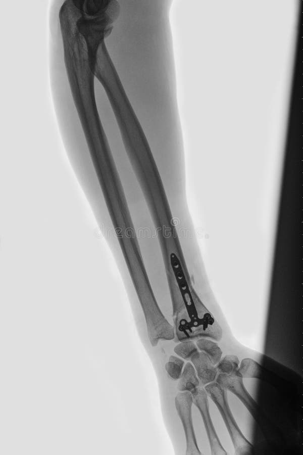 Broken hand stock image. Image of artificial, roentgen - 66312025