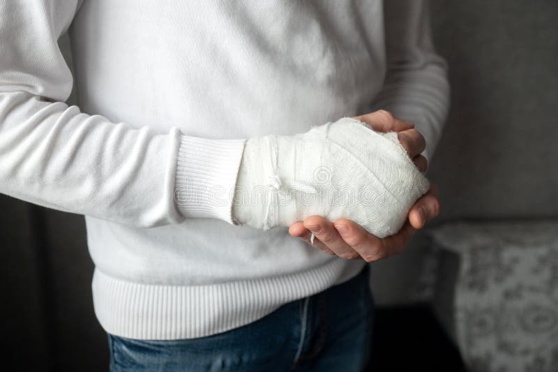 A Man S Broken Arm in a Cast Stock Image - Image of disability, medical ...