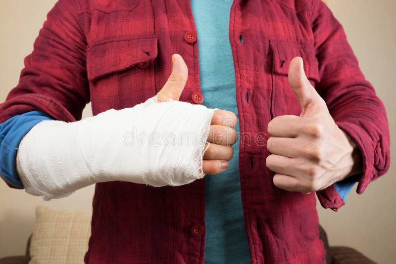 Broken hand stock image. Image of bone, cast, fracture - 69476067