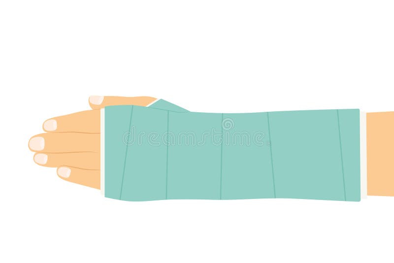 Broken hand with plaster stock vector. Illustration of hand - 281300673