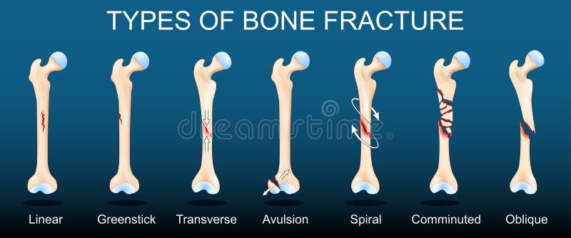 Broken Human Femurs on Dark Background Stock Vector - Illustration of ...