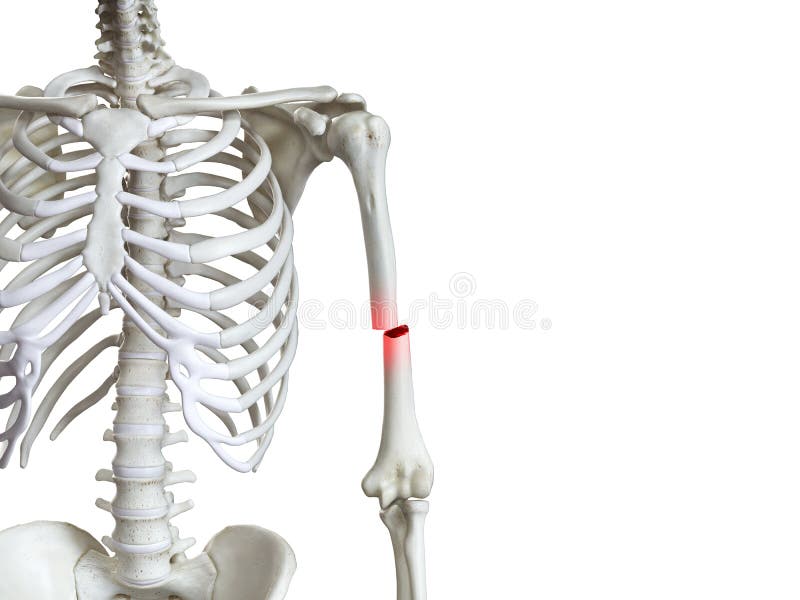 A broken humerus stock illustration. Illustration of white - 157583393