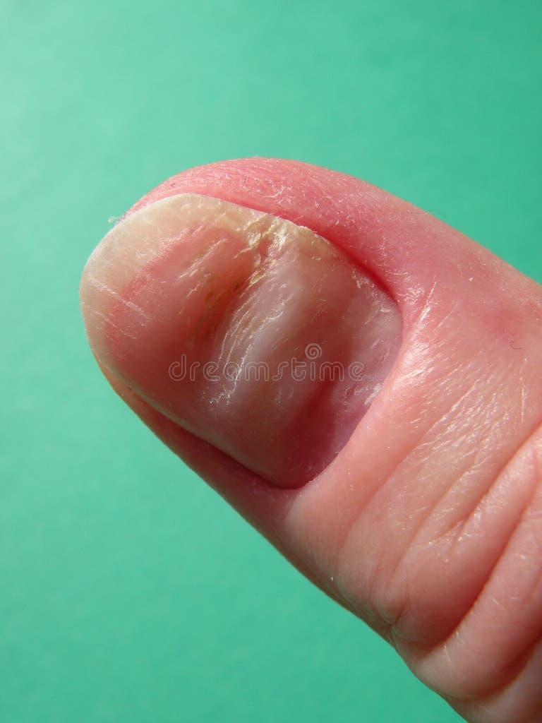895 Deformed Finger Nail Stock Photos - Free & Royalty-Free Stock ...