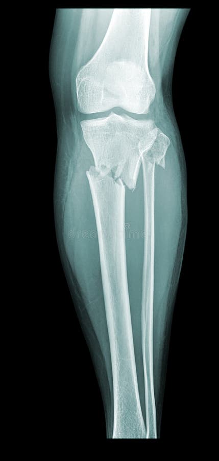 Broken leg stock illustration. Illustration of exam, skeleton - 13362440