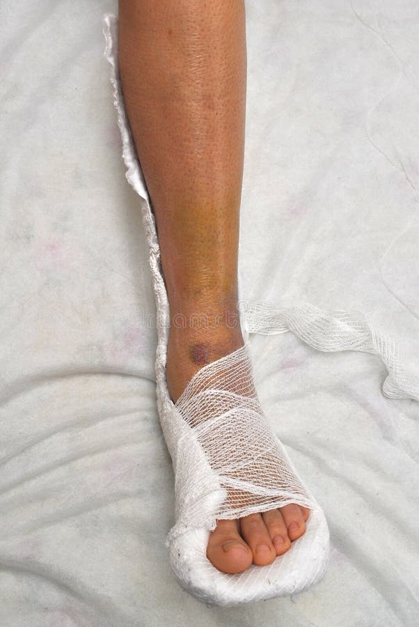 Broken leg stock photo. Image of bandage, leave, ankle - 18399286