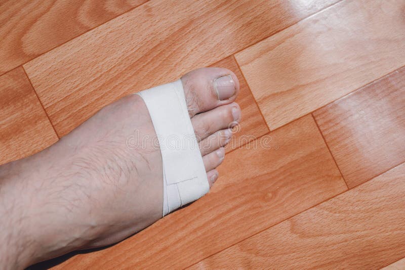 Broken leg. stock photo. Image of anatomy, hospital - 122100638